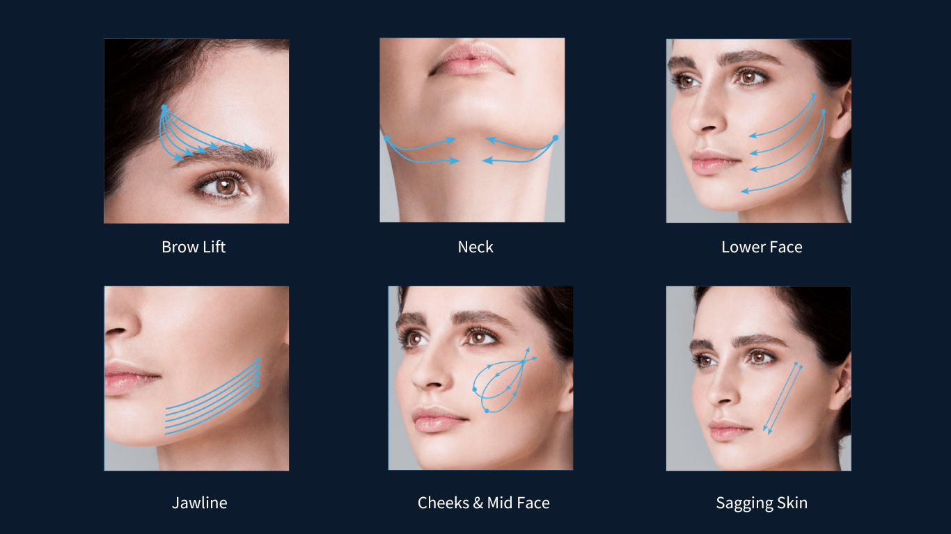 Aptos Thread Lift - Da Vinci Clinic