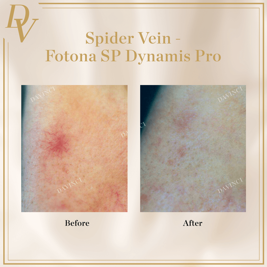 Spider Vein Treatment Malaysia | Varicose Vein Removal