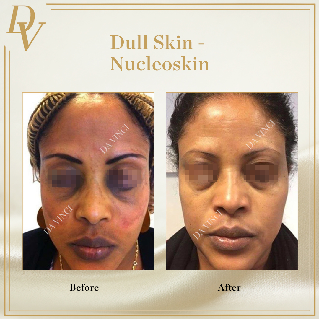 Nucleoskin - Da Vinci Clinic