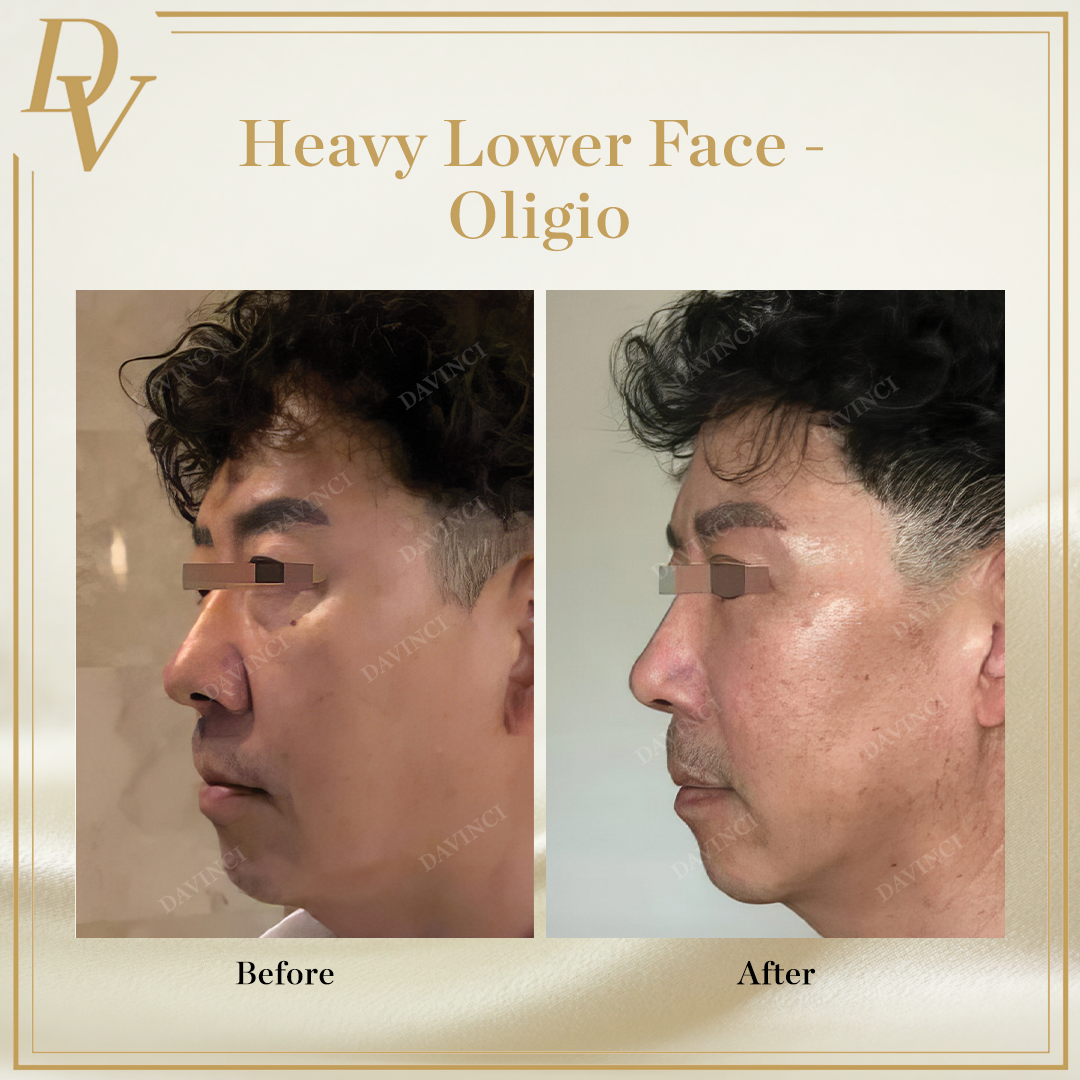 Oligio Treatment | Skin Tightening