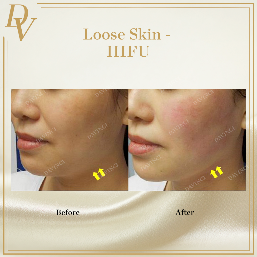 HIFU Treatment Malaysia | Non-Surgical Facelift Clinic