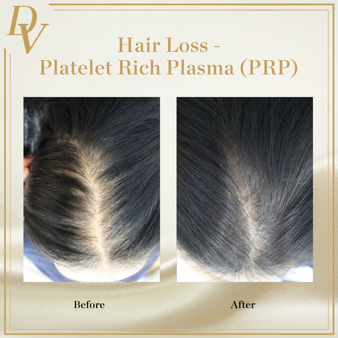 Platelet Rich Plasma (PRP) - Da Vinci Clinic
