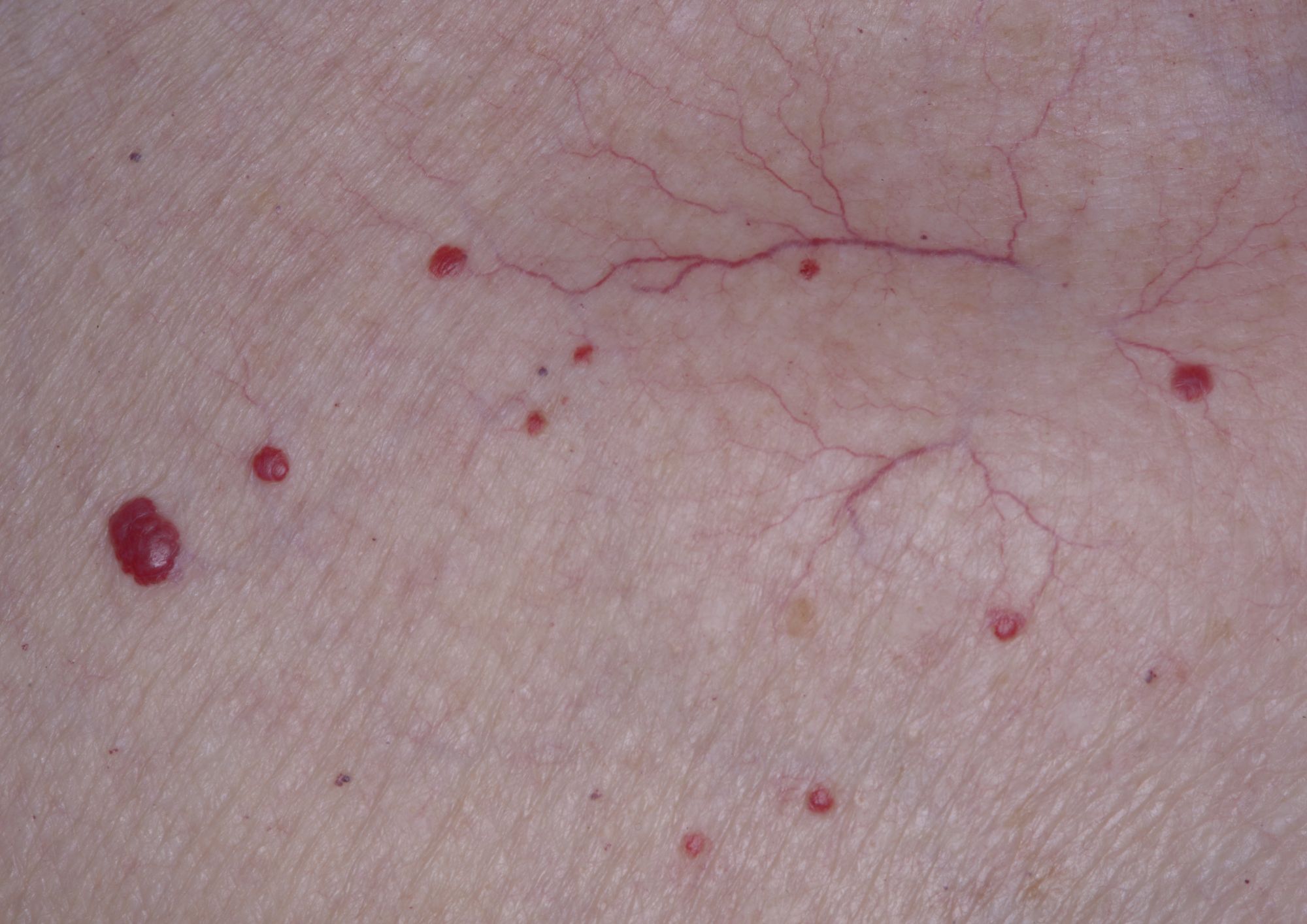 Cherry Angioma Removal Malaysia | Da Vinci Clinic - Da Vinci Clinic