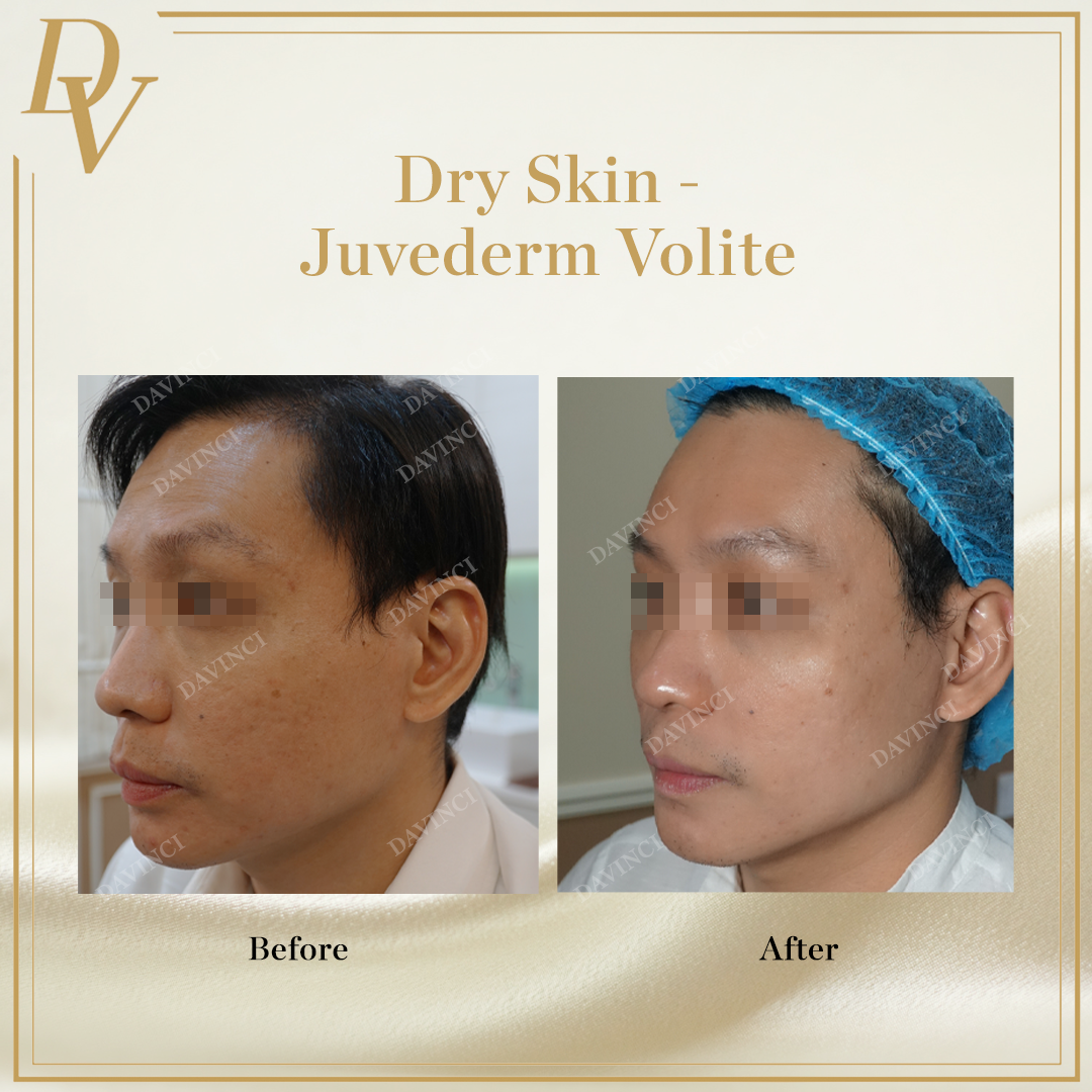Juvederm Volite - Da Vinci Clinic