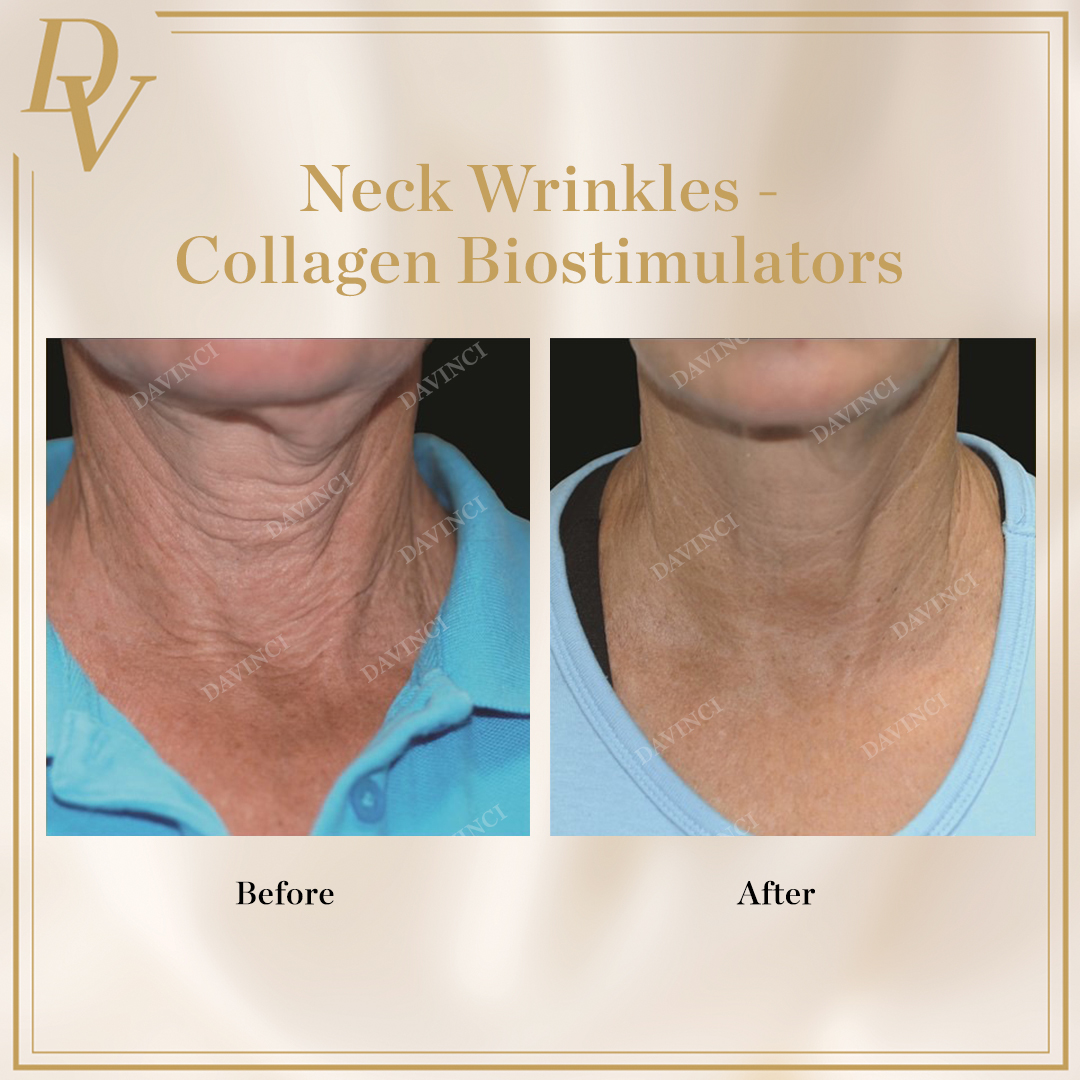 Collagen Biostimulators | Facial Contouring & Volume