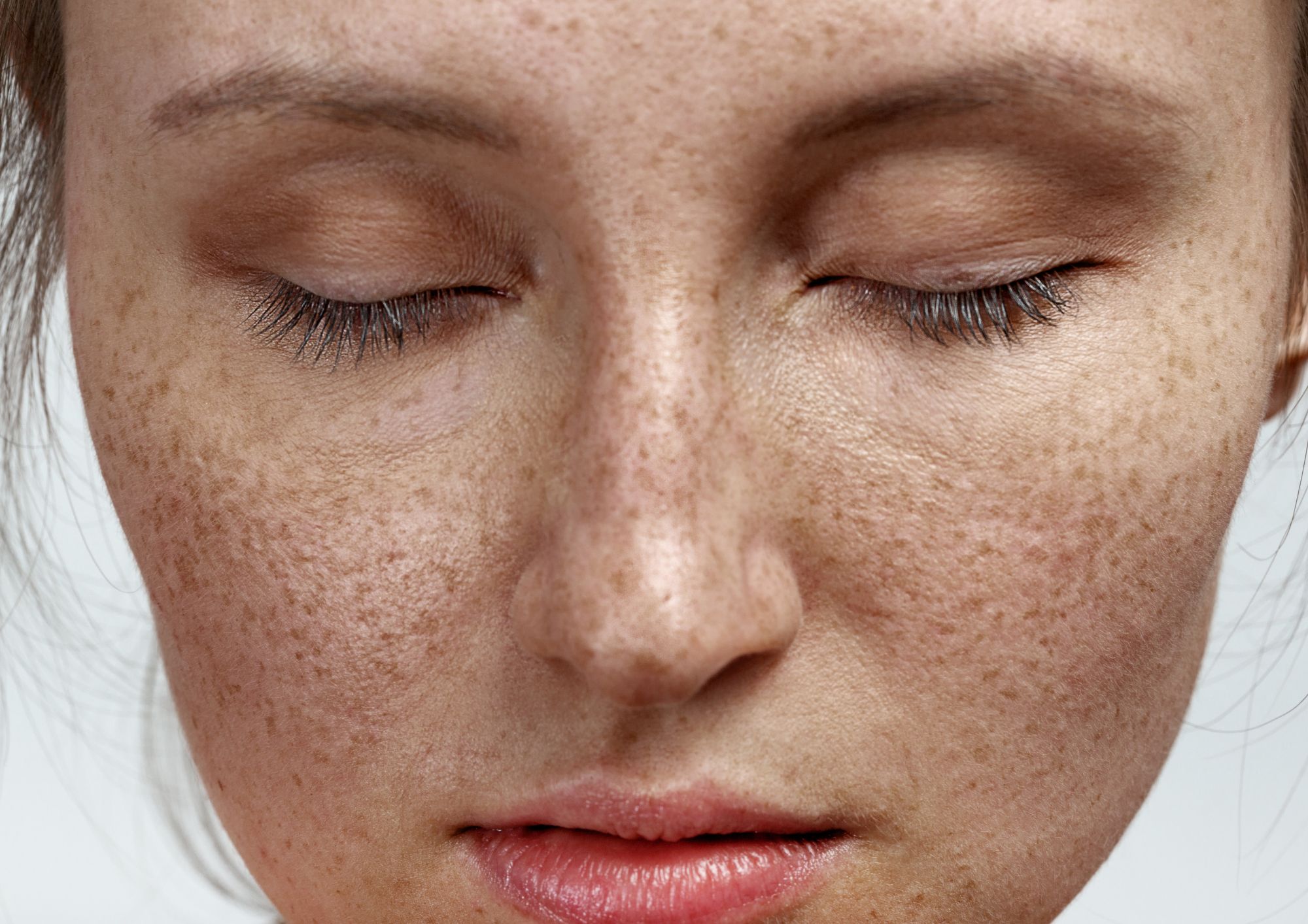 What Are Freckles and How to Treat Them Effectively? - Da Vinci Clinic